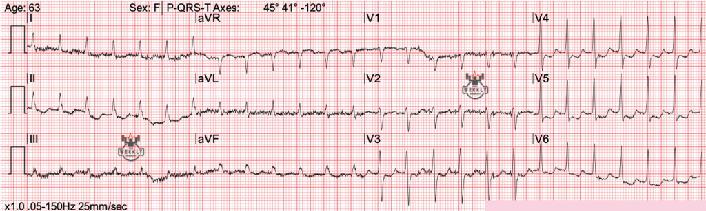 EMS ECGs: S1Q3T3, is it pathognomonic for acute pulmonary embolism – ECG Weekly