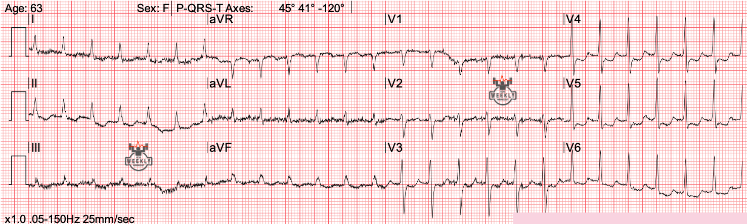 EMS ECGs: S1Q3T3, is it pathognomonic for acute pulmonary embolism ...
