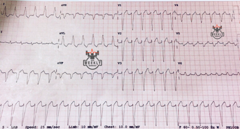 Rhythm Interpretation: using lewis leads to nail the diagnosis – ECG Weekly