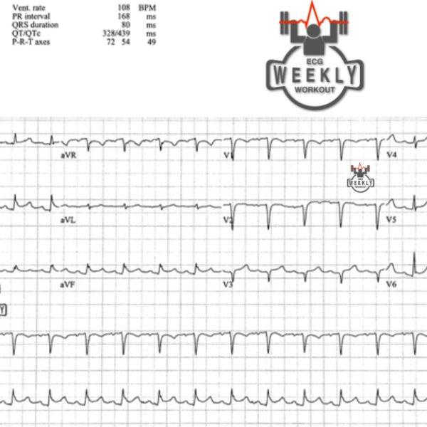 Pericardial Tamponade – ECG Weekly