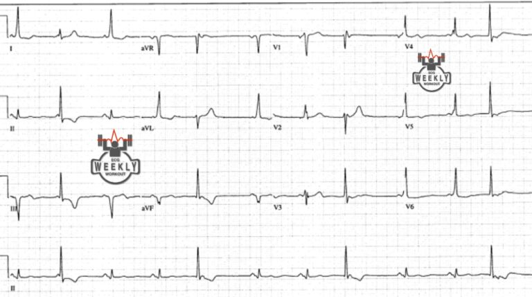 Stepwise approach to ECG interpretation: systematic rhythm ... Stepwise approach to ECG interpretation: systematic rhythm ...