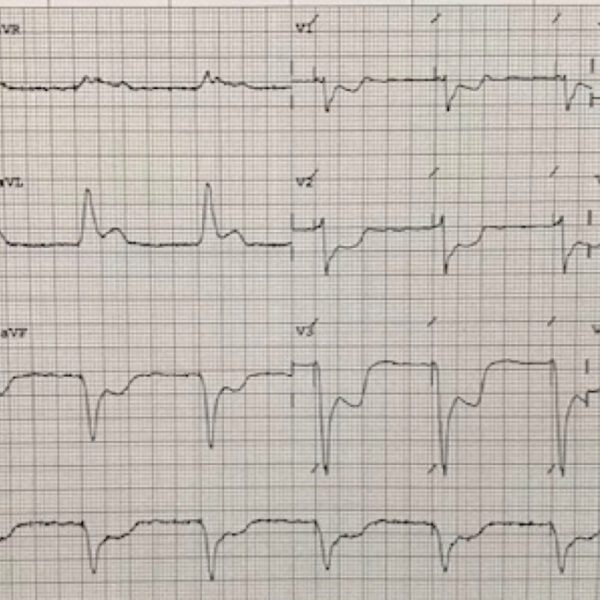 Posterior STEMI – ECG Weekly