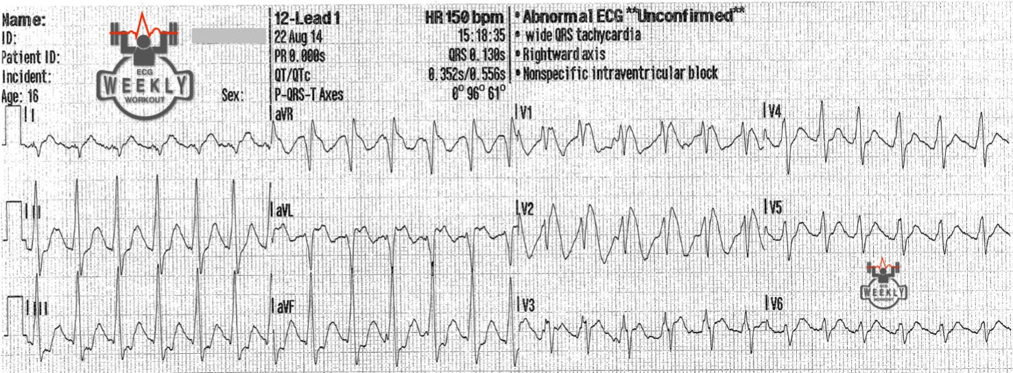 STAT ECG Diagnoses: the ECG findings in sodium channel blocker toxicity ...