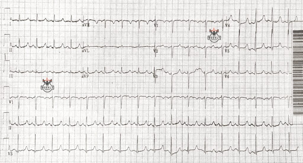 ECG Basics & Fundamentals: causes of prolonged ST segment – ECG Weekly