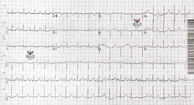 ECG Basics & Fundamentals: causes of prolonged ST segment – ECG Weekly ECG Basics & Fundamentals: causes of prolonged ST segment – ECG Weekly