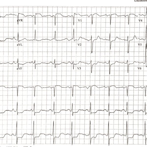 Aortic Dissection – ECG Weekly
