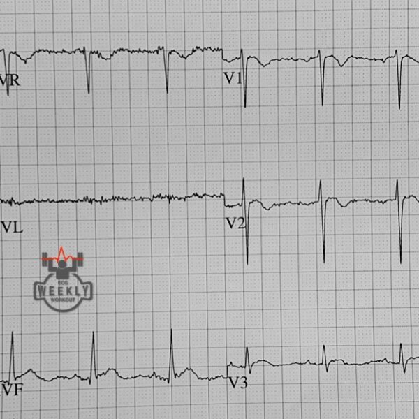 Hypercalcemia – ECG Weekly