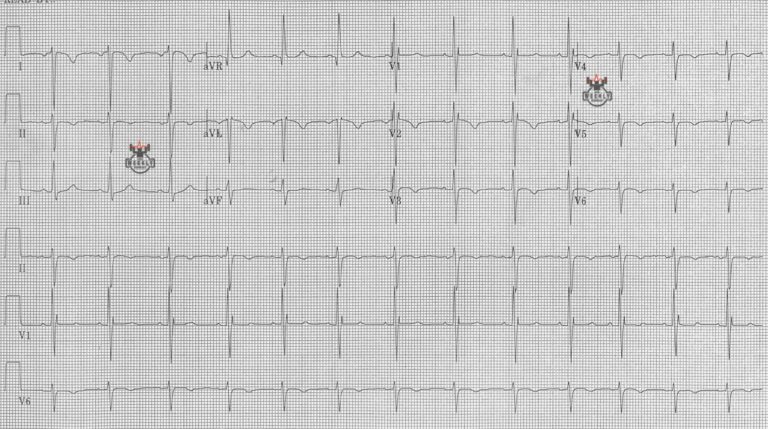 ECG Basics & Fundamentals: ECG findings of dextrocardia – ECG Weekly
