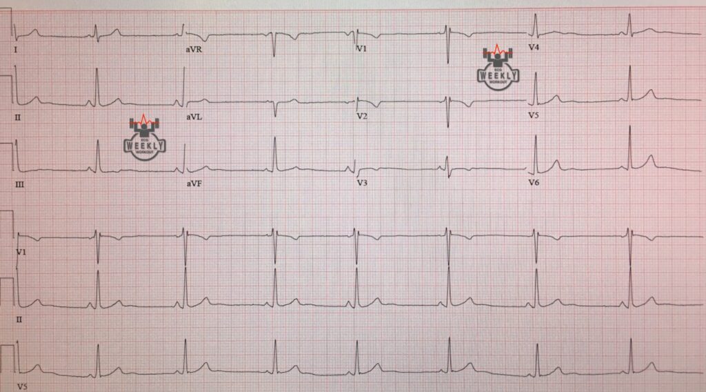 Differential Diagnoses: the many causes of T wave inversions – ECG Weekly