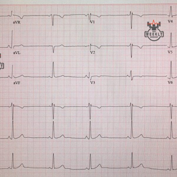 Persistent juvenile T-wave pattern – ECG Weekly
