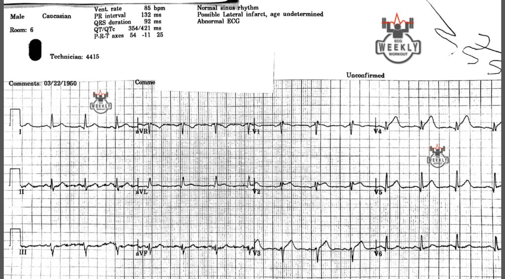 ECG Basics & Fundamentals: Hyperacute T waves – ECG Weekly