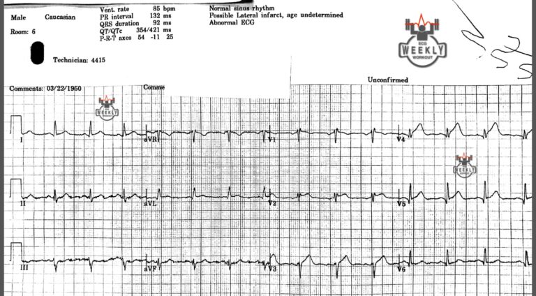 ECG Basics & Fundamentals: Hyperacute T waves – ECG Weekly