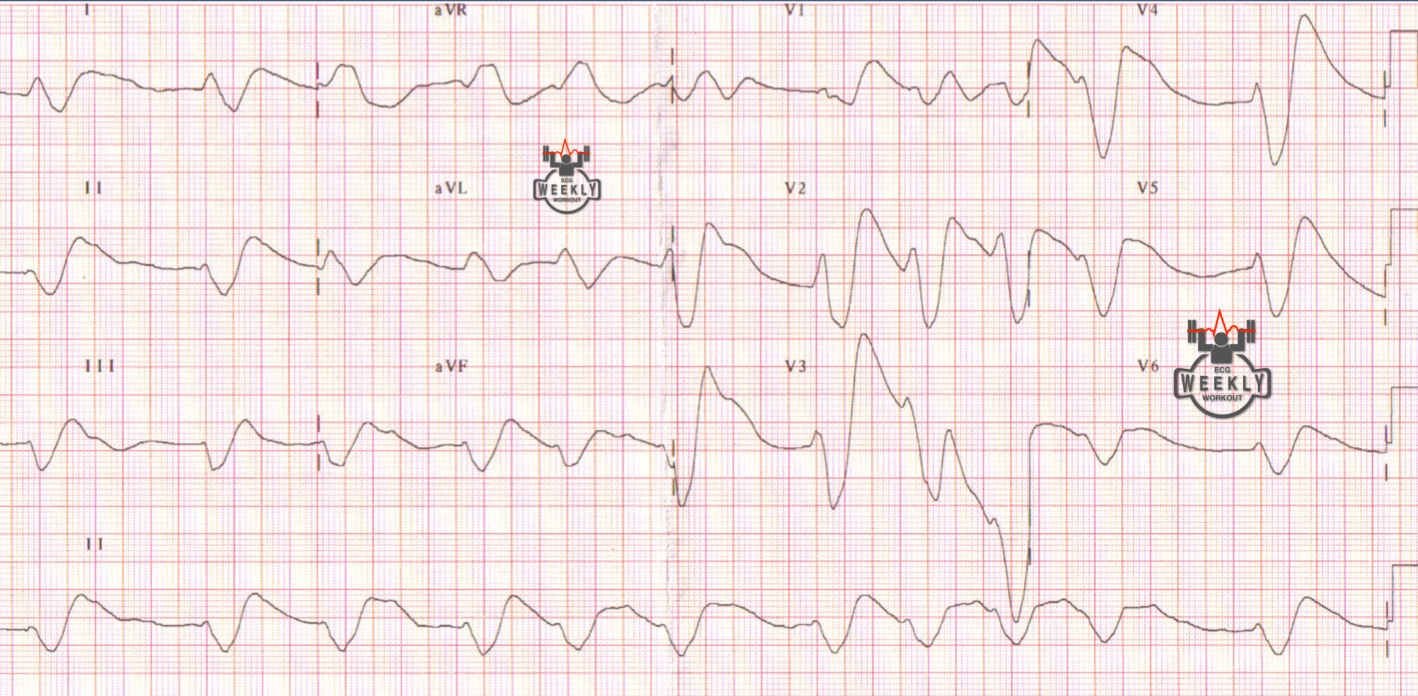 STAT ECG Diagnoses: the value of ECGs in acute neurological emergencies ...
