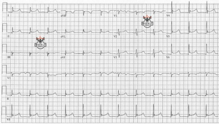 Differential Diagnoses: terminal QRS distortion in the differentiation ...