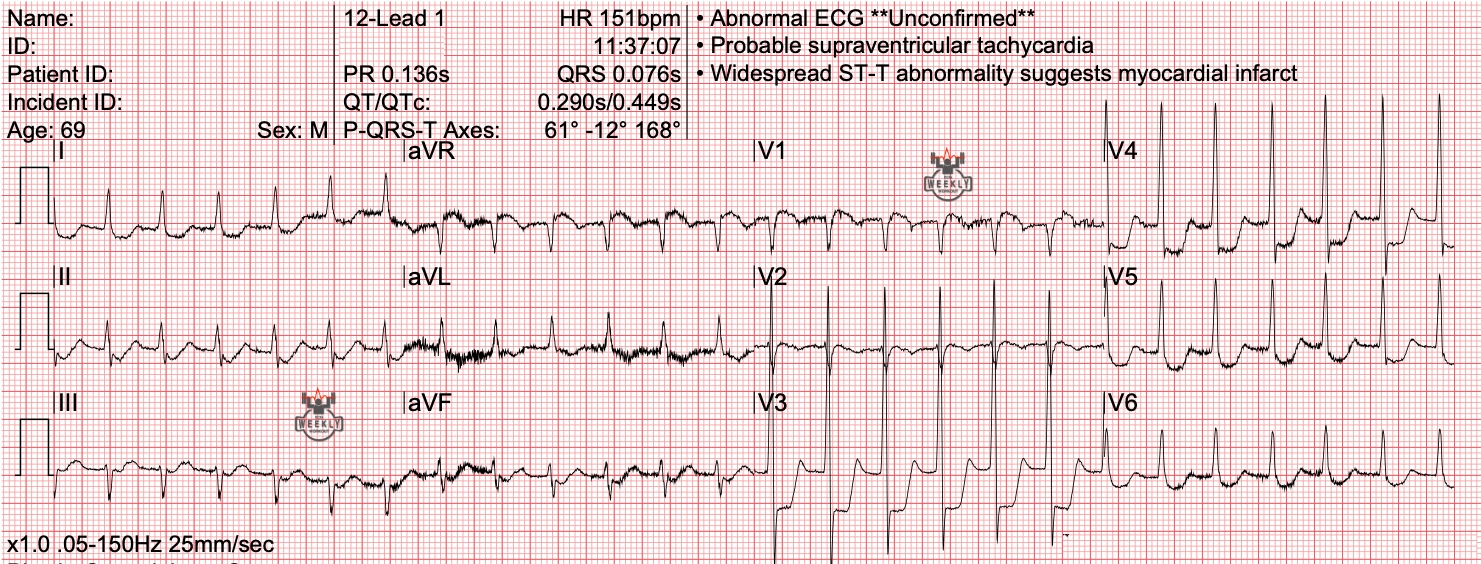 EMS ECGs: opportunity to save lives prehospital by recognizing severe ...