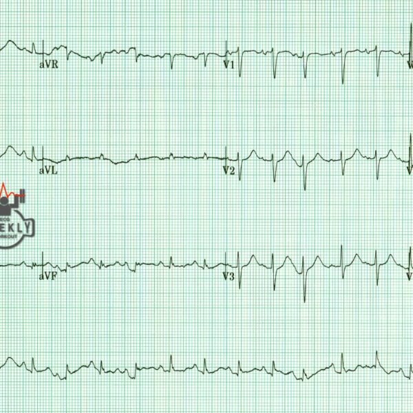 Pericardial effusion – ECG Weekly