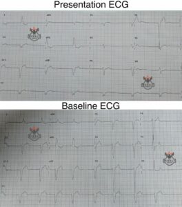 STAT ECG Diagnoses: chronic atrial fibrillation with bradycardia and hypotension – ECG Weekly