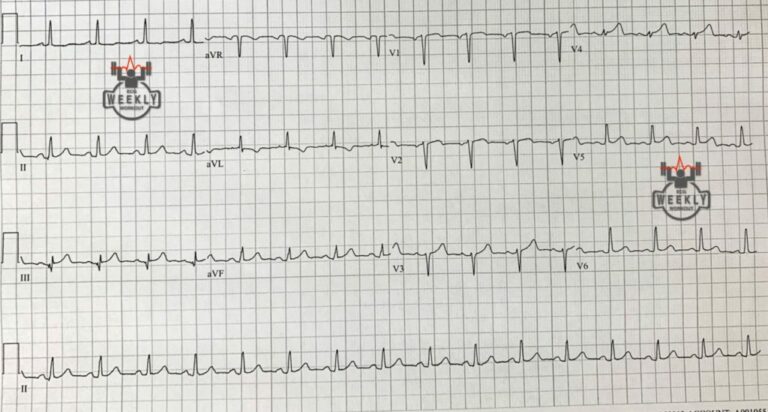 Differential Diagnoses: poor R wave progression and attention to T wave ...