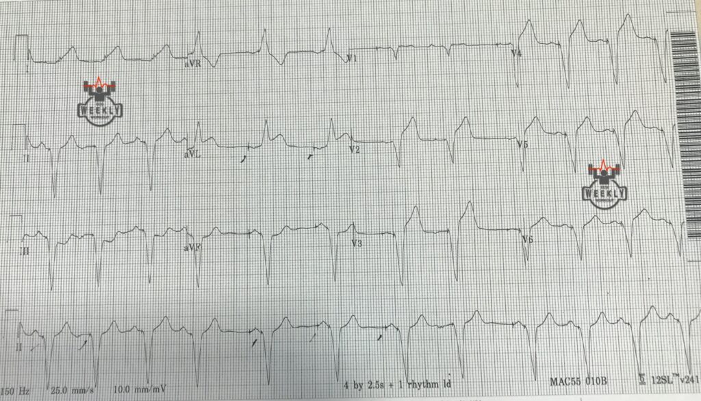ECG Basics and Fundamentals: expected ECG findings in right ventricular ...