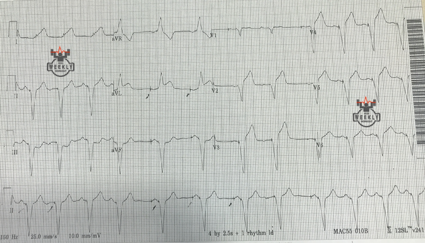 Ecg Basics And Fundamentals Expected Ecg Findings In Right Ventricular