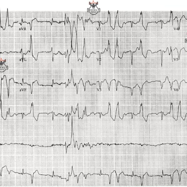 PVCs – ECG Weekly