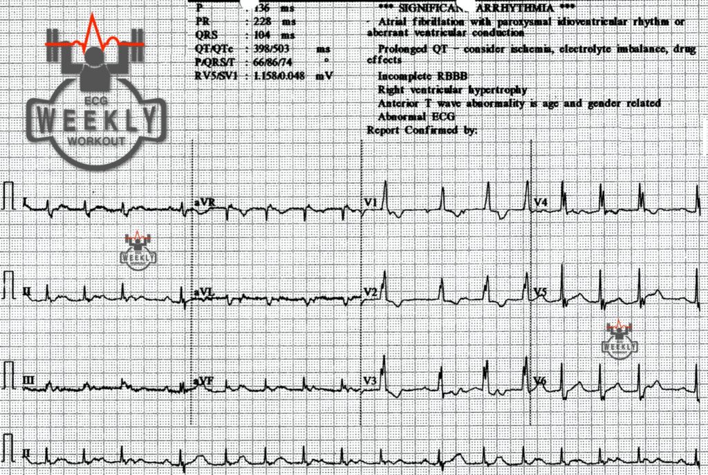 Rhythm Interpretation: how to avoid misdiagnosis of atrial fibrillation ...