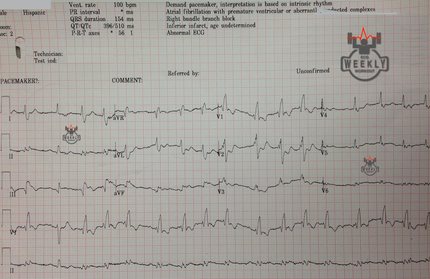 Rhythm Interpretation: grouped or clumped beats – ECG Weekly