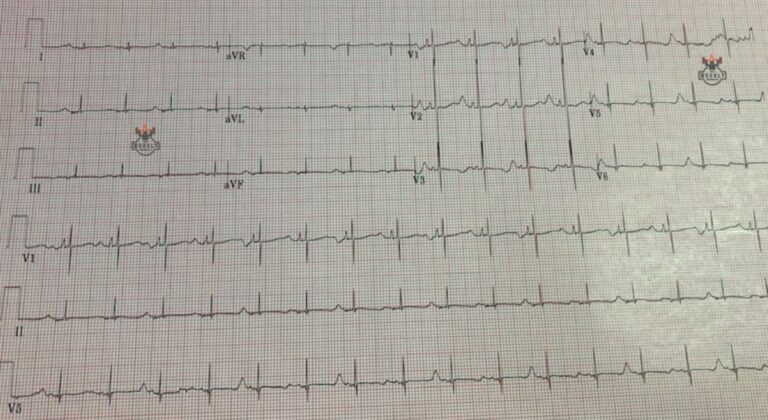 STAT ECG Diagnoses: abnormal T waves and T wave alternans – ECG Weekly