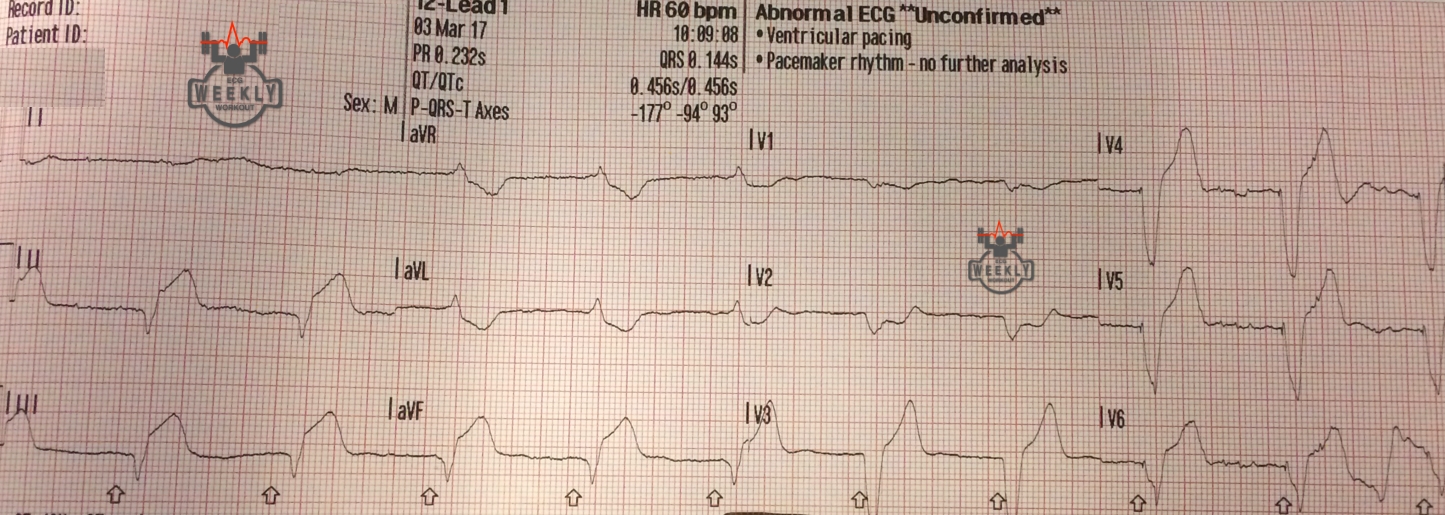Literature Review: modified Sgarbossa criteria in the diagnosis of acute coronary occlusion MI ...