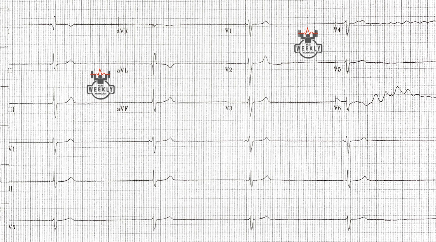 STAT ECG Diagnoses: bradycardia, renal failure, AV nodal blockade ...