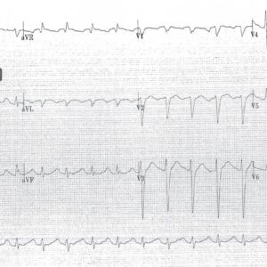 Right Axis Deviation – ECG Weekly