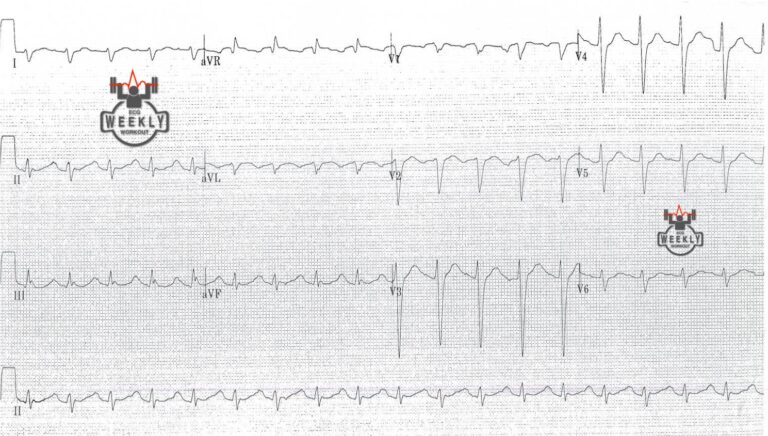 STAT ECG Diagnoses: how to use ECG differentials to clinc the diagnosis in patients who are ...
