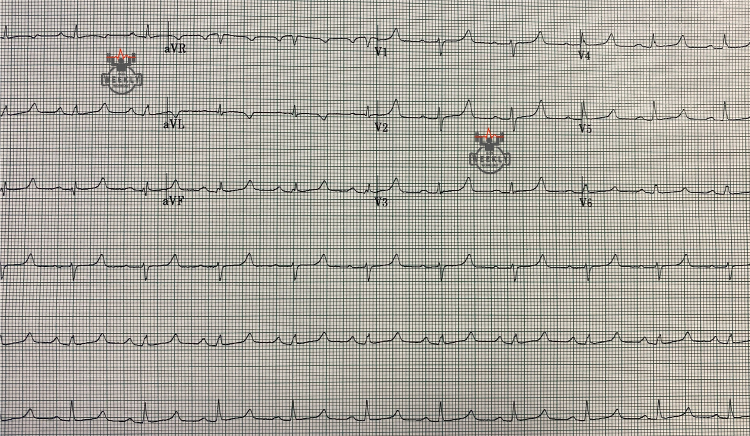 Differential Diagnoses: large T waves and prolonged QT intervals – ECG Weekly