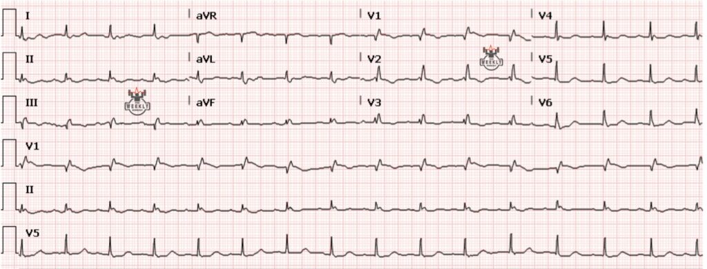 ECG Basics & Fundamentals: interval abnormalities can cause clinical ...