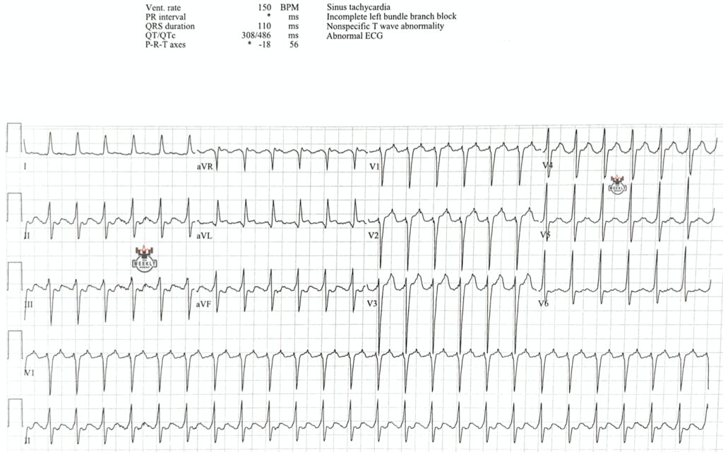 Differential Diagnoses: narrow complex regular tachycardias – ECG Weekly