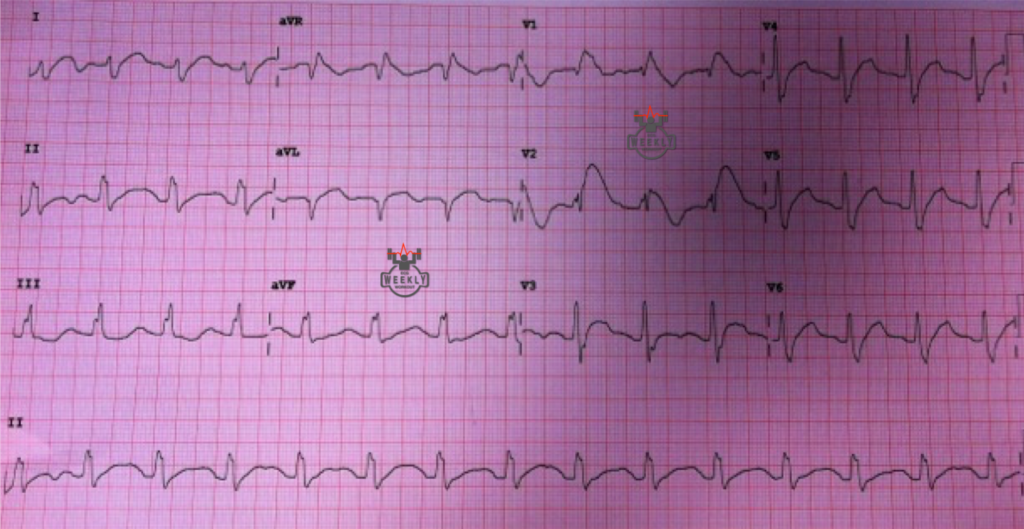 ECG Basics and Fundamentals: A stepwise approach to ECG interpretation ...