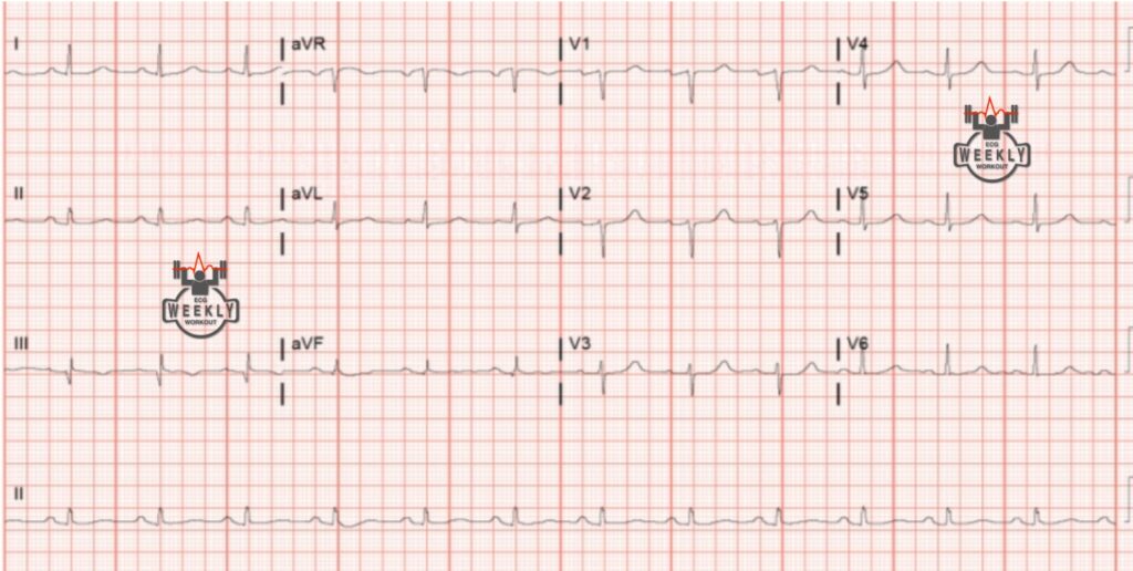 ECG Basics & Fundamentals: new tall upright T waves in lead V1 – ECG Weekly