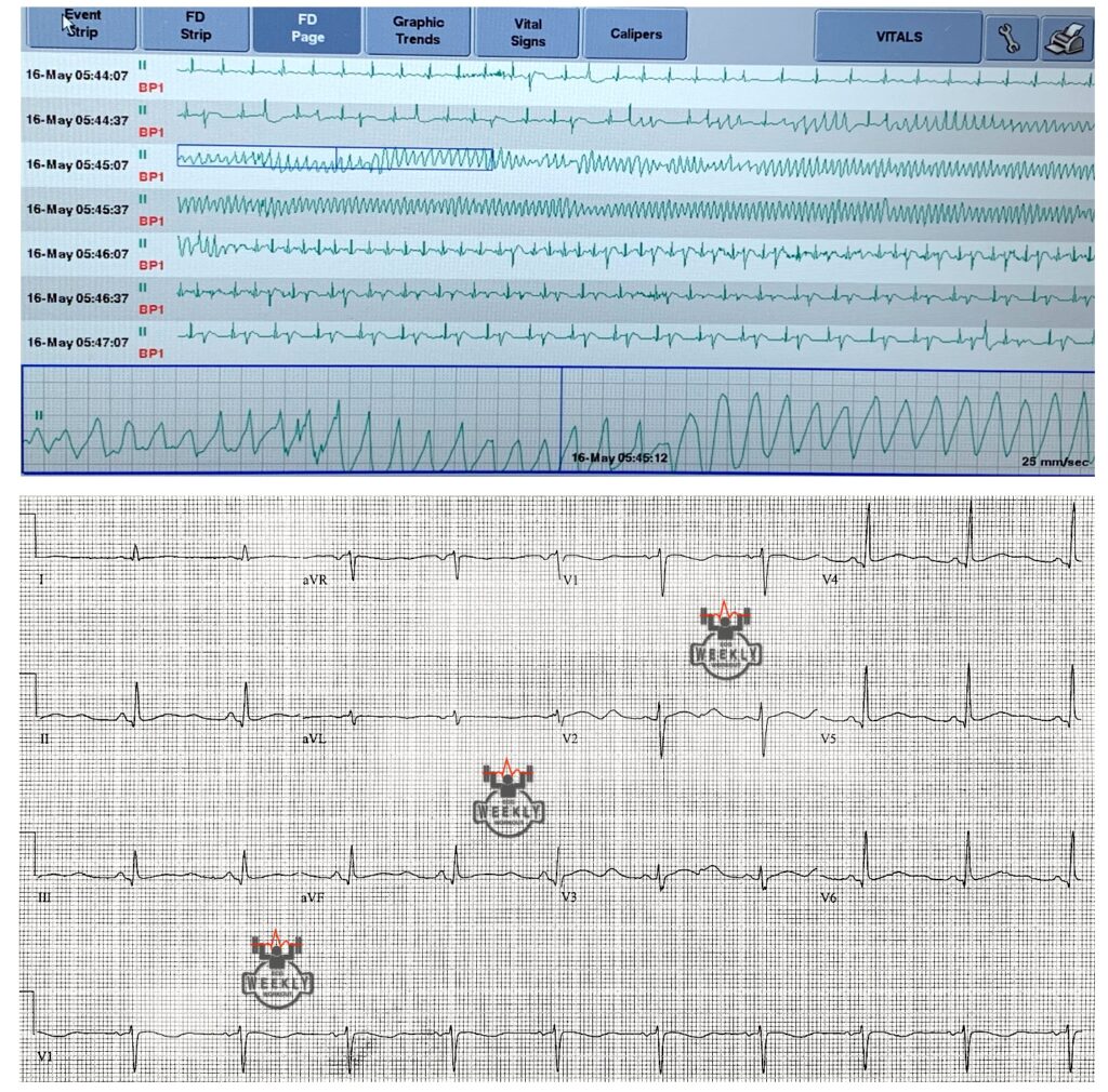 ECG Basics & Fundamentals: cardiac rhythm strips and how to identify the three main types of ...