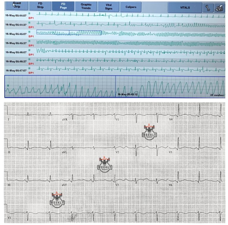 ECG Basics & Fundamentals: cardiac rhythm strips and how to identify ...