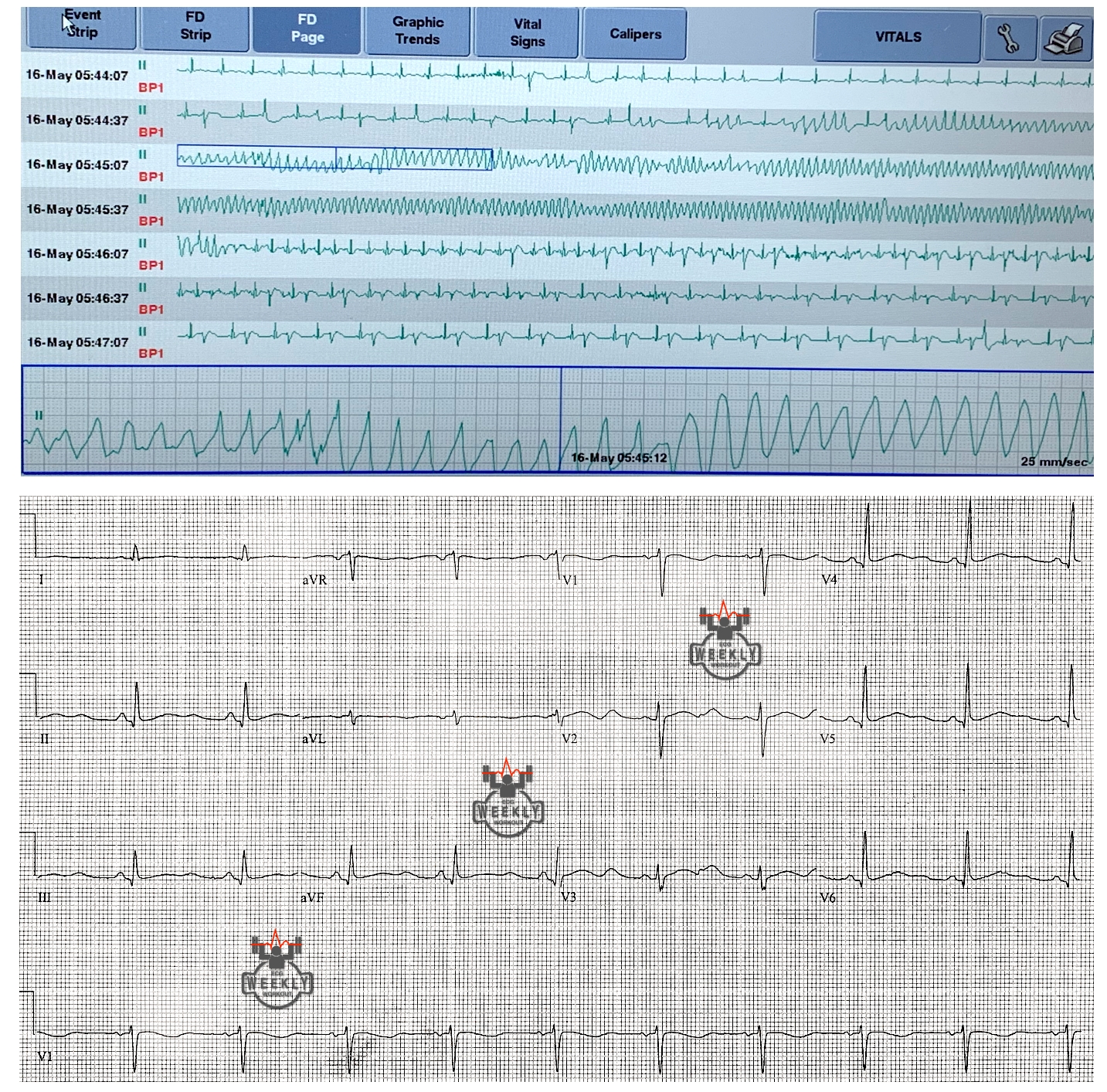 ECG Basics & Fundamentals: cardiac rhythm strips and how to identify ...