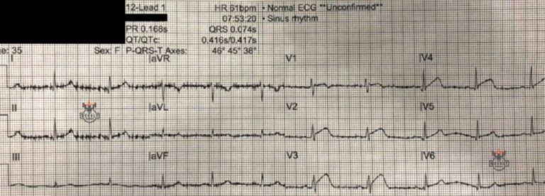 ECG Basics & Fundamentals: how reliable are reciprocal changes in the ...