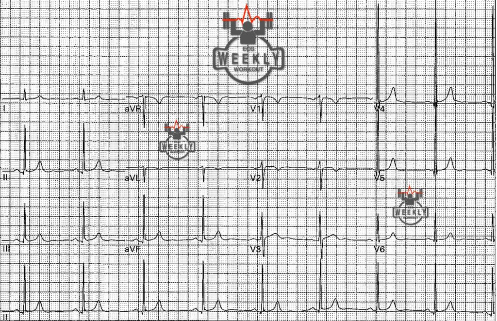 Literature Review: can inverted U waves in the lateral leads predict heart disease? – ECG Weekly