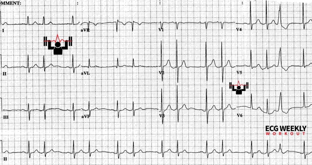 STAT ECG Diagnoses: what to consider when dealing with grouped or ...