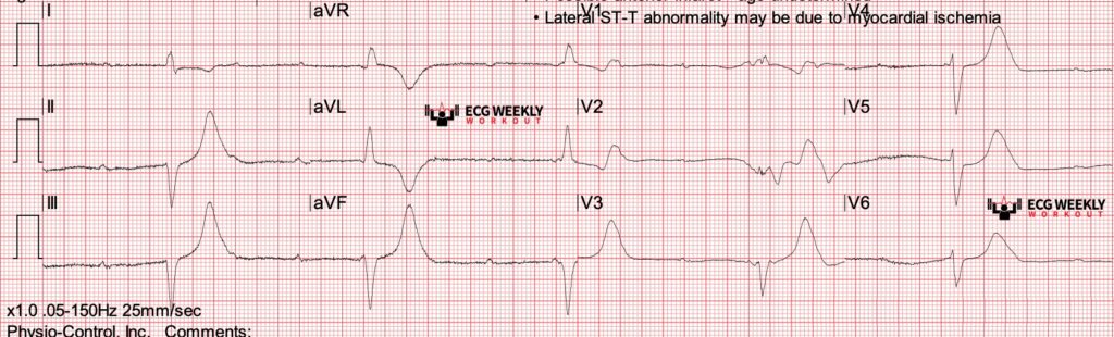 AV Block Bootcamp (Episode 1/3): differential diagnoses for non ...
