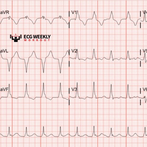 Ventricular rhythms – ECG Weekly