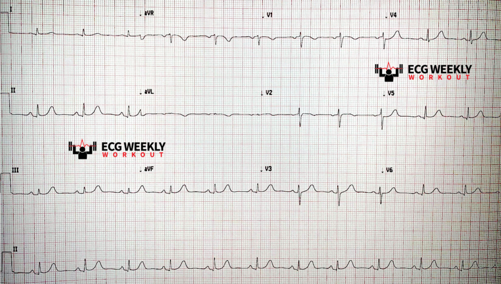 STAT ECG Diagnoses: what is the signifcance of a new T wave inversion in aVL? – ECG Weekly