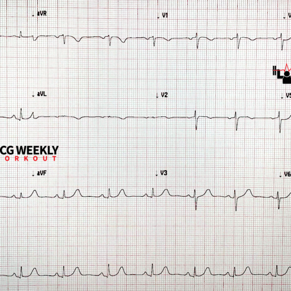 Ventricular Rhythms – ECG Weekly