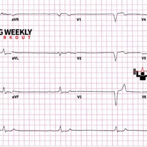 Digoxin toxicity – ECG Weekly