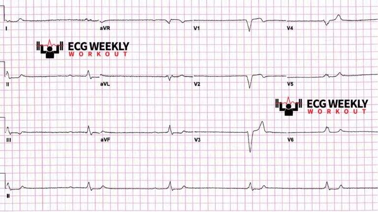 STAT ECG Diagnoses: ECG findings of digoxin effect vs. digoxin toxicity ...