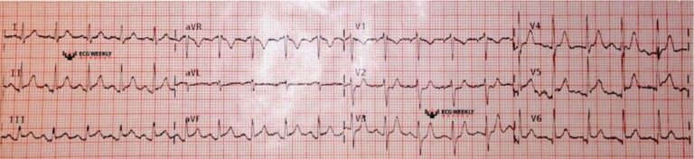 Literature Review: evaluation of Spodick’s sign and other ...
